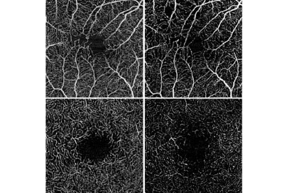 New uveitis monitoring approach