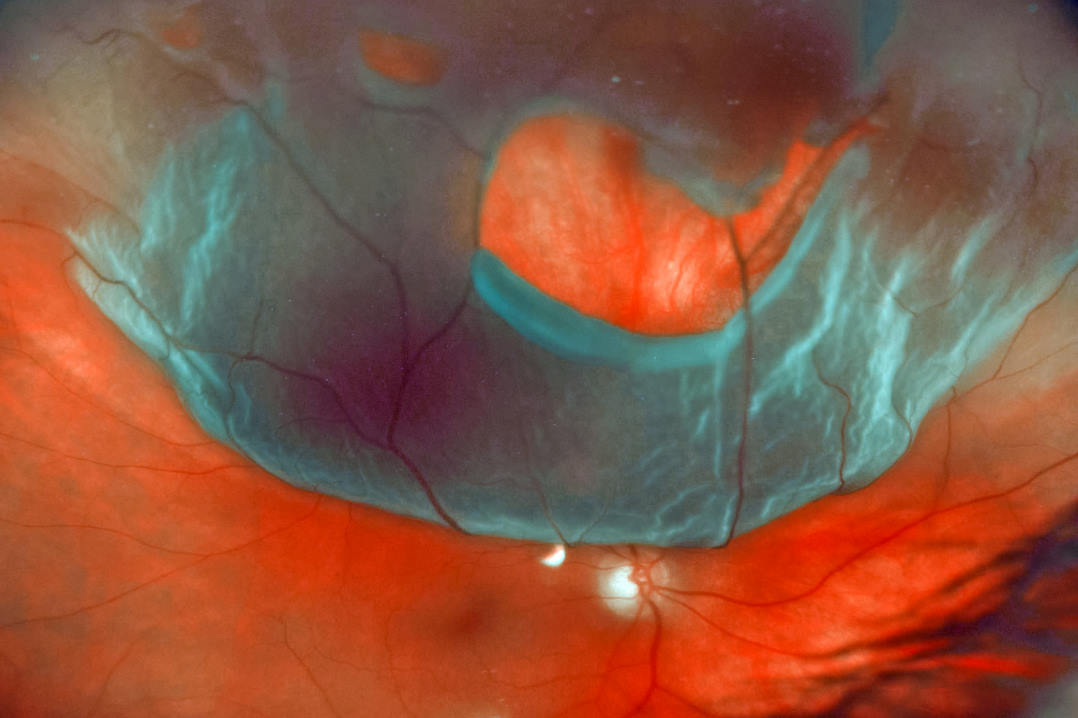 Retinal detachment patch improves post-op care