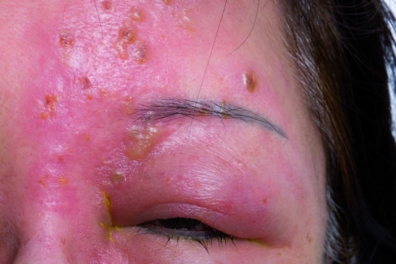 Valacyclovir reduces eye shingles pain