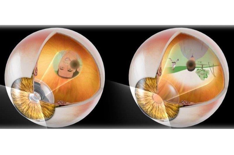 Intraocular telescope implanted in NZ